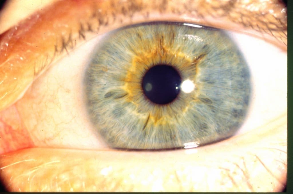 What The Mean Iridology Yellow Ring Around Pupil Iriscope What The Mean Iridology Yellow Ring Around Pupil Iriscope