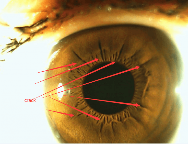 Iridology Case - Crack Case – MAIKONG Iridology Camera - Iriscope ...