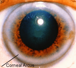 Why Iridology White Ring Around Iris? – MAIKONG Iridology Camera ...