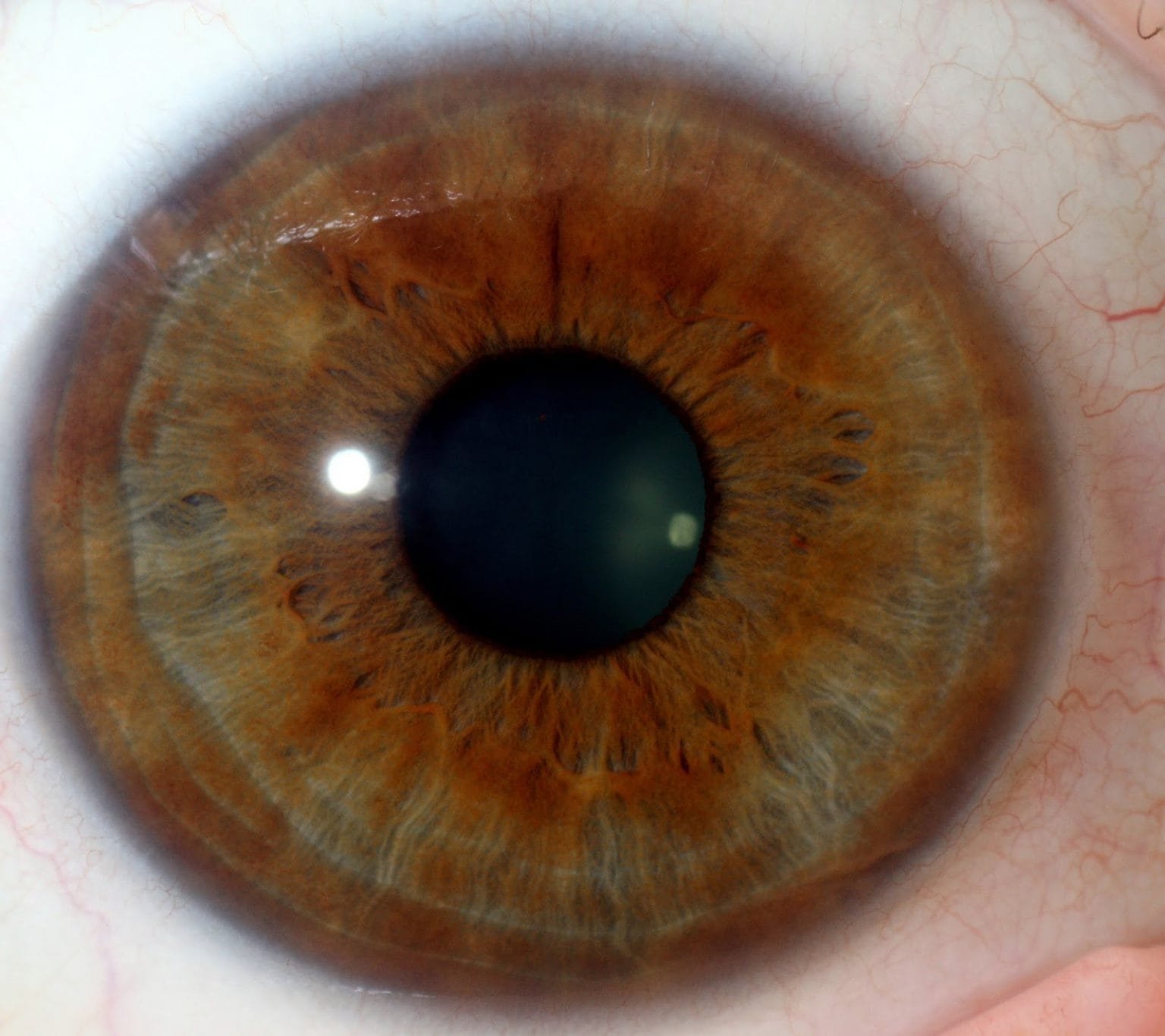 What Does A White Line Mean In Iridology – MAIKONG Iridology Camera ...